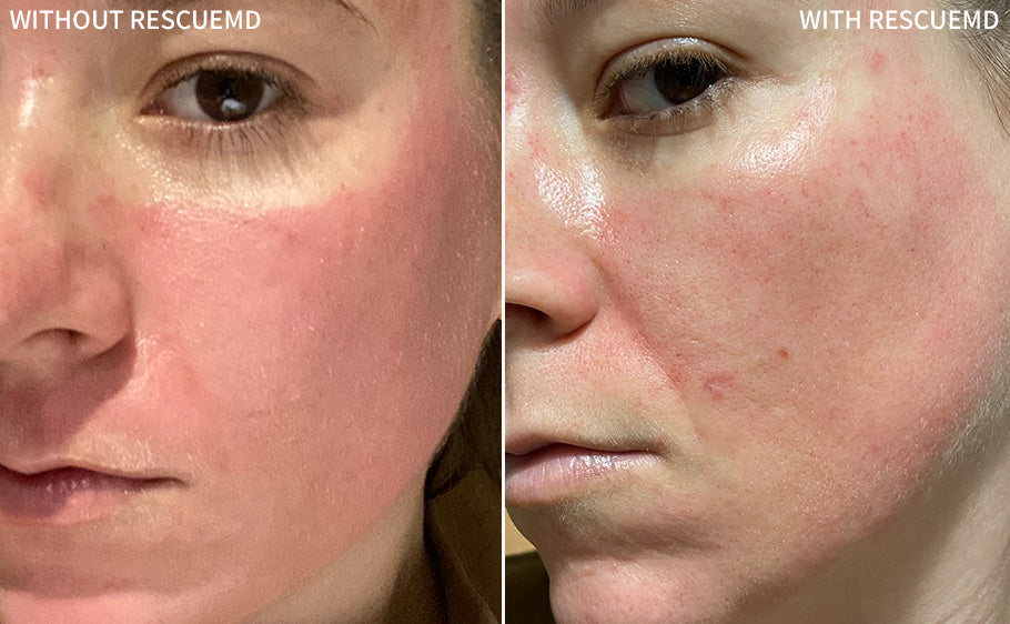 Post Microneedling 3 Days Post Microneedling 3 Days